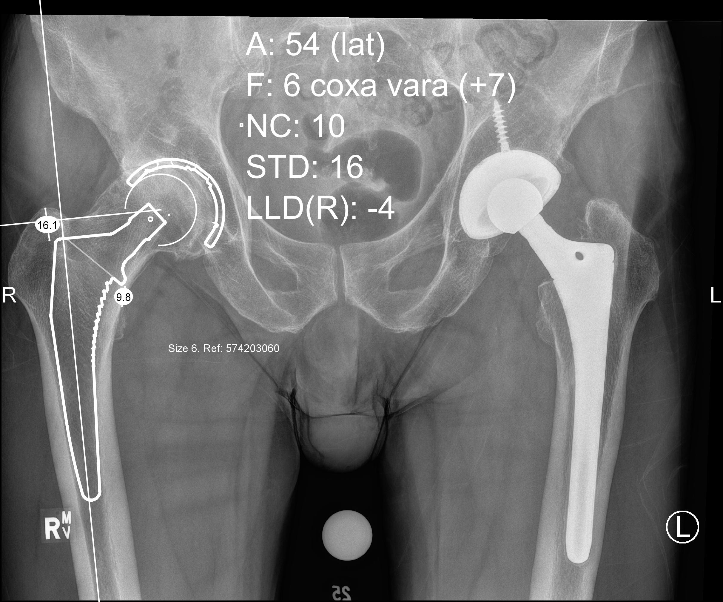 Templating | The Bone School